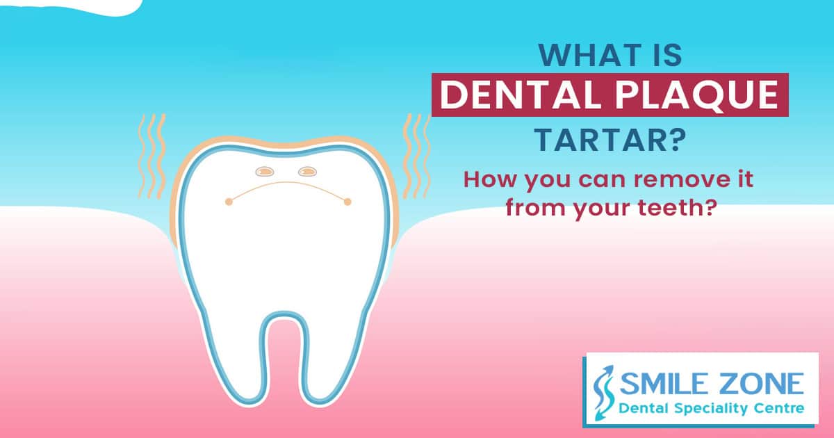 What is dental plaque, tartar? How you can remove it from your teeth